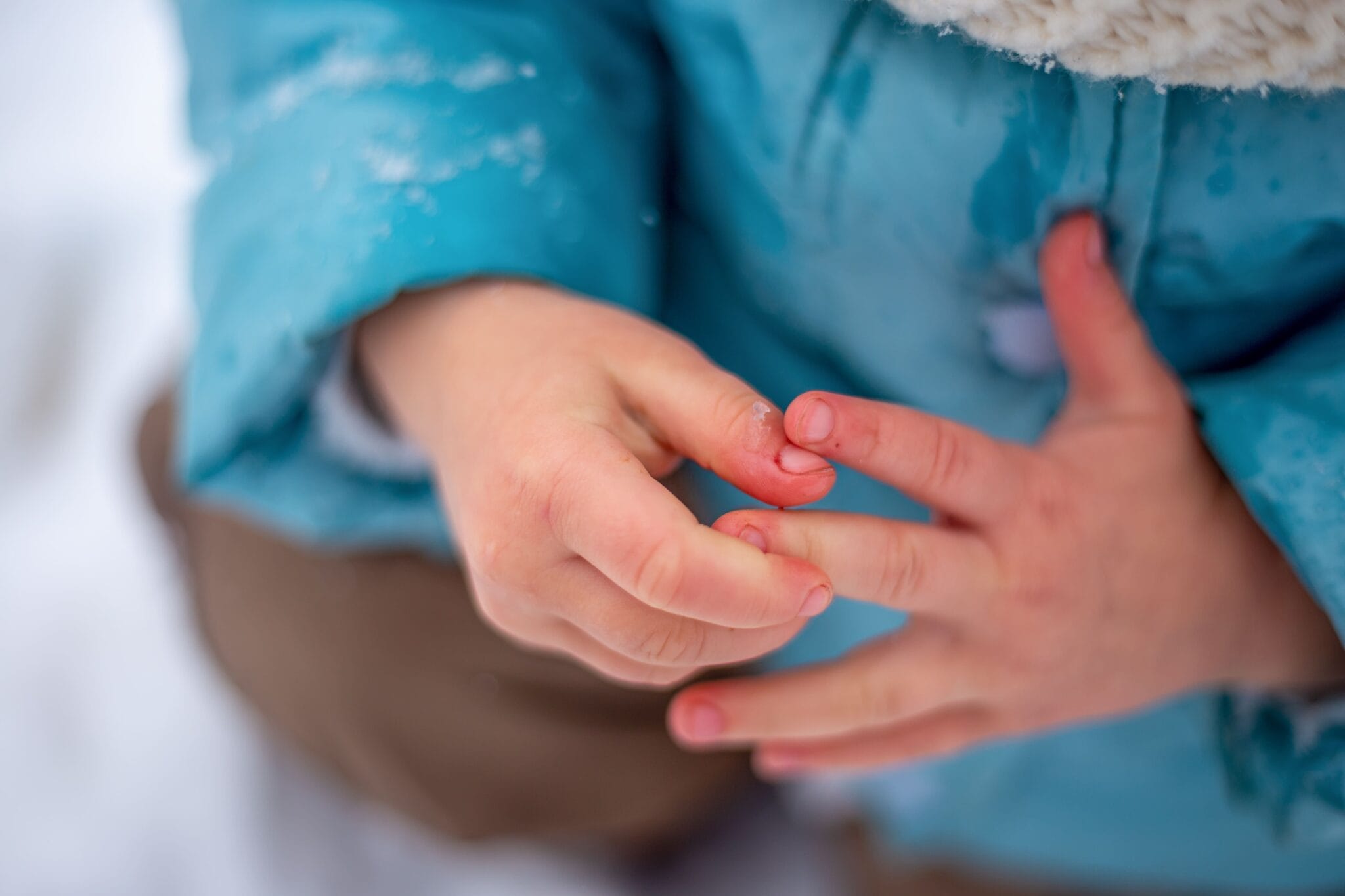 Apa Itu Frostbite? Kenali Gejala dan Cara Mengatasinya